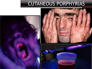 Porphyrias | PPTX