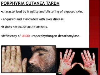 Cutaneous Porphyrias Eyes Clipart