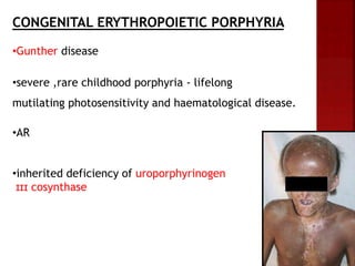 Gunther Porphyria