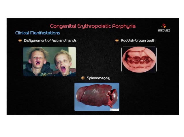 PORPHYRIAS presentationsndclimical features.pptx