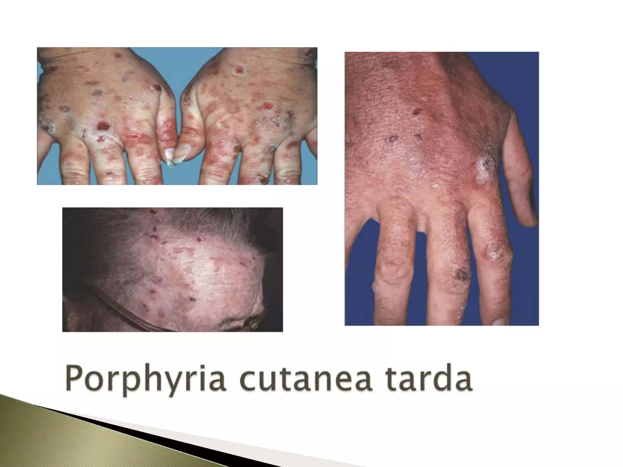 Porphyrias | PPT