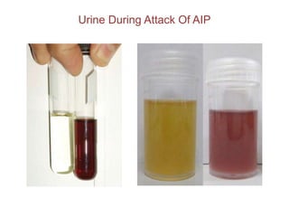Acute Intermittent Porphyria Urine