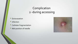Port a-cath | PPTX