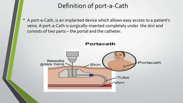 Port a-cath | PPT