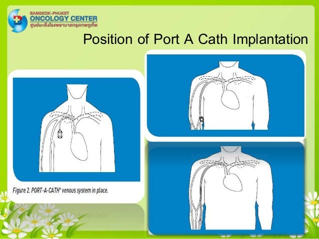 Port a cath By Oncology Center Bangkok Phuket Hospital