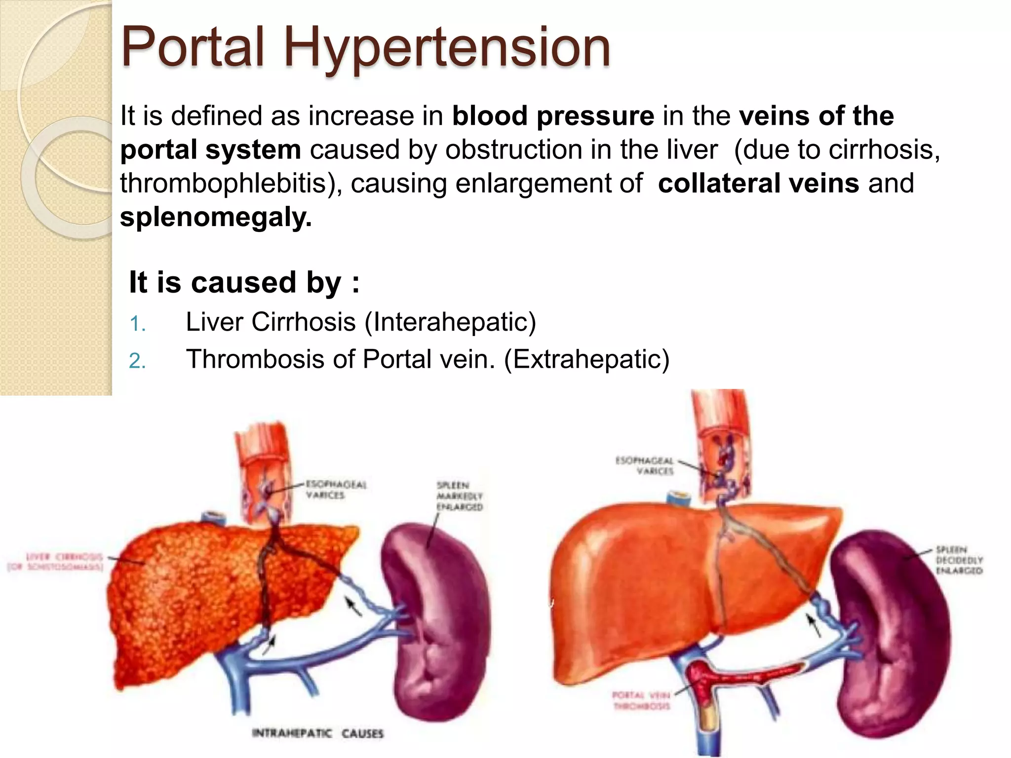 portacaval anastomosis | PPTX