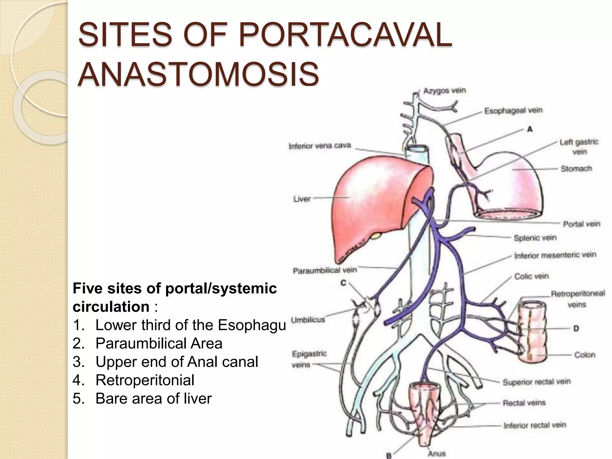 portacaval anastomosis | PPTX