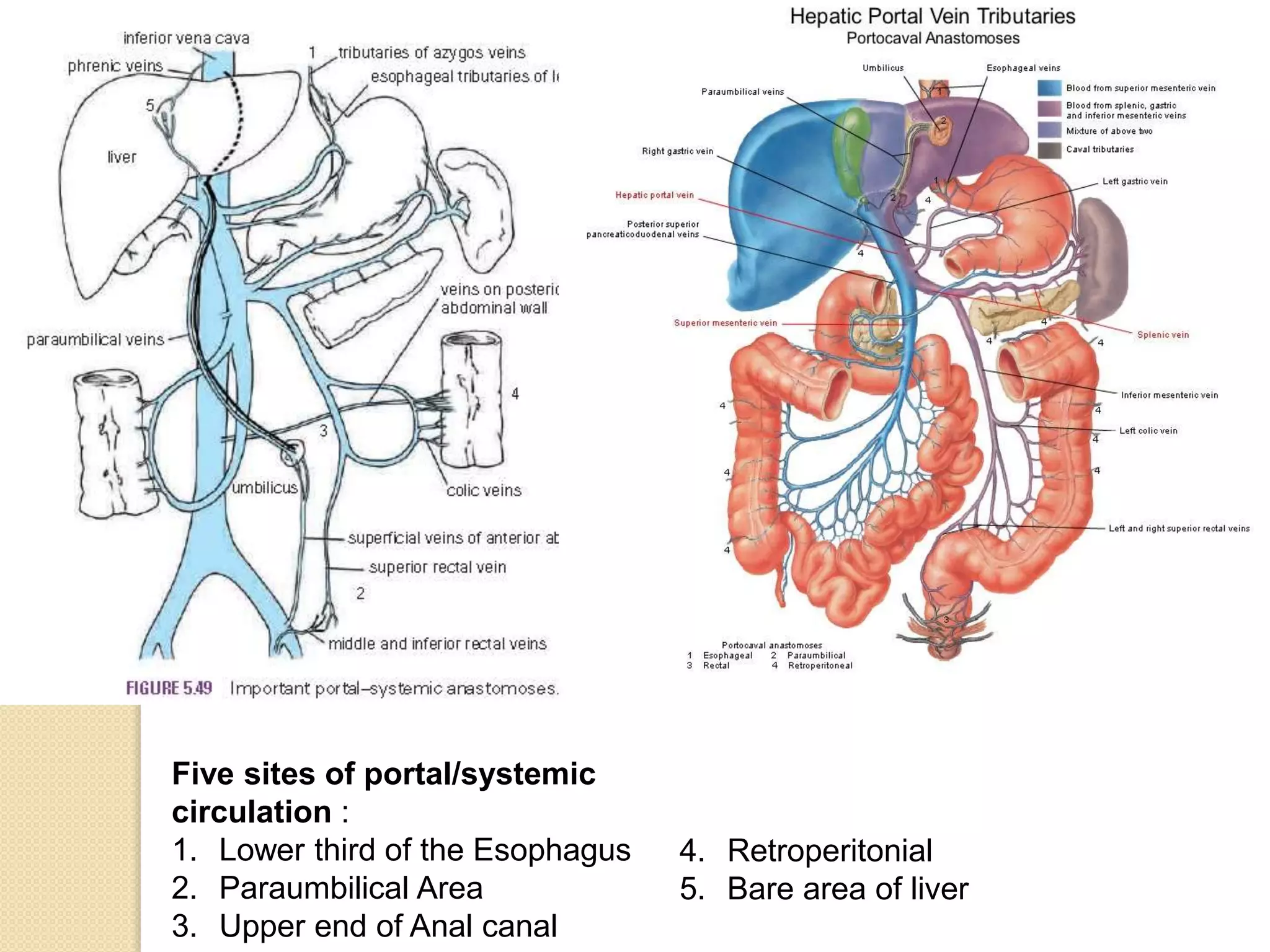 portacaval anastomosis | PPTX