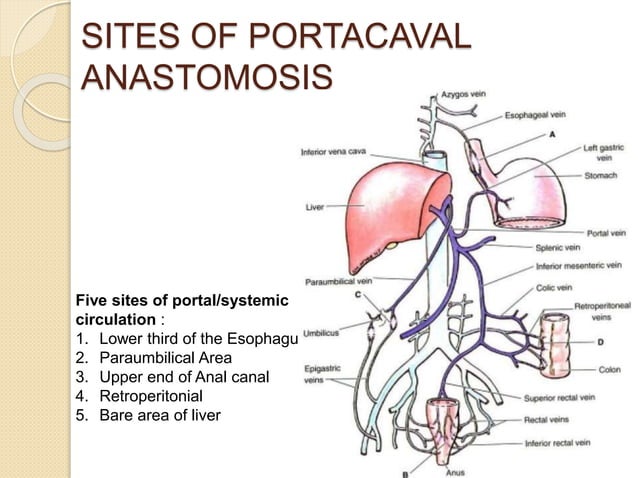 portacaval anastomosis | PPTX
