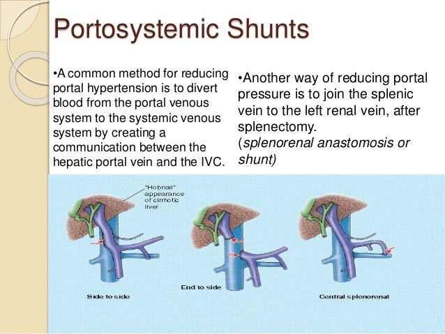 portacaval anastomosis