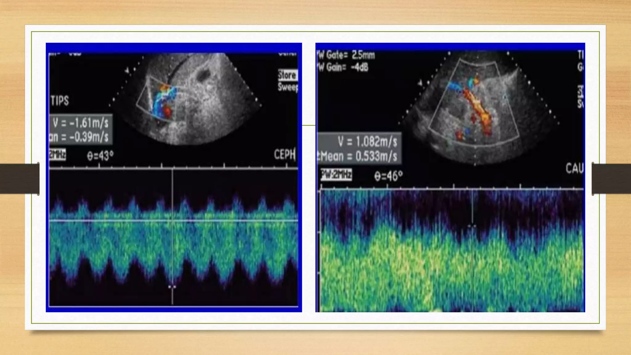 portal doppler ppt .pptx