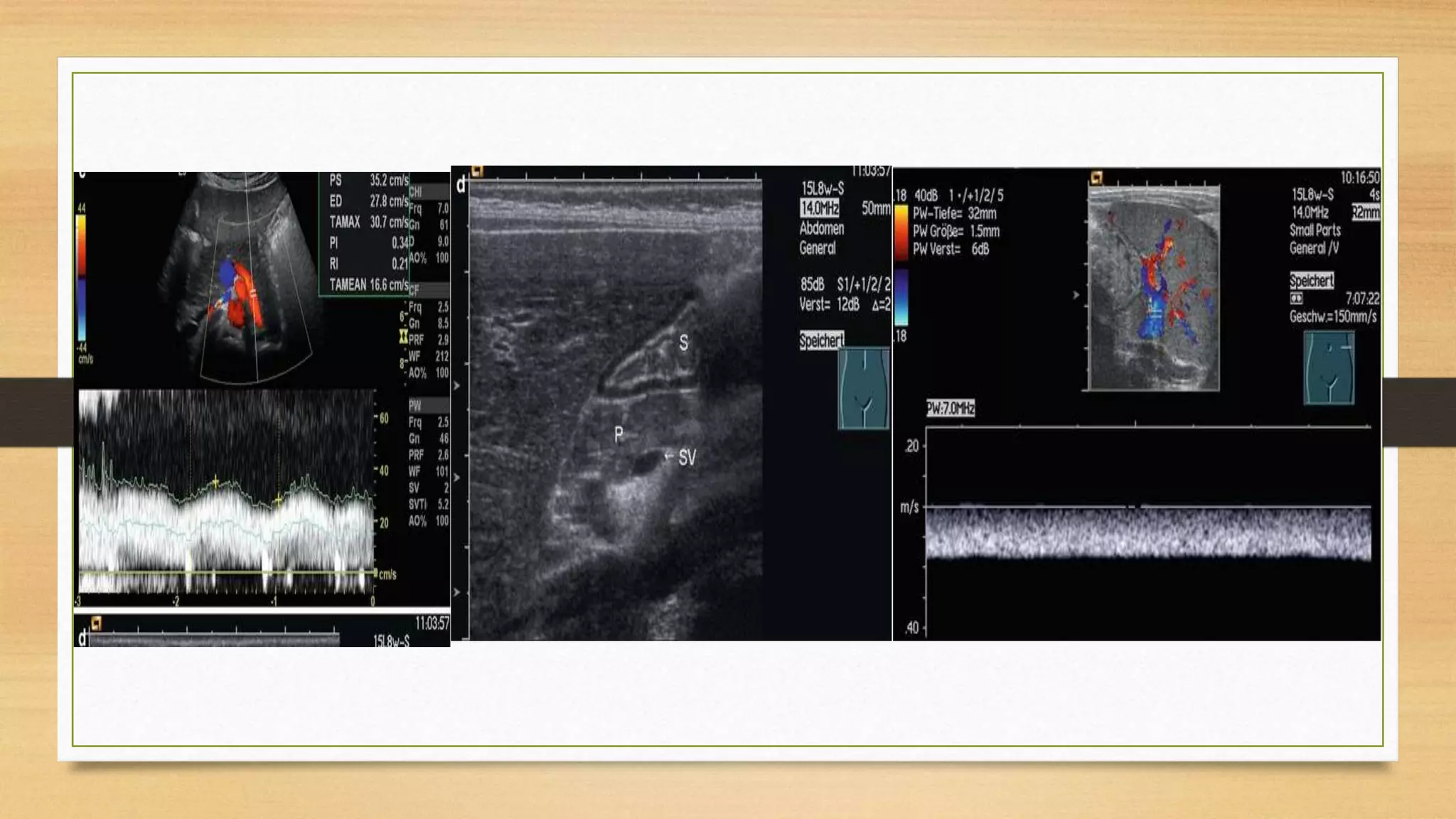 portal doppler ppt .pptx