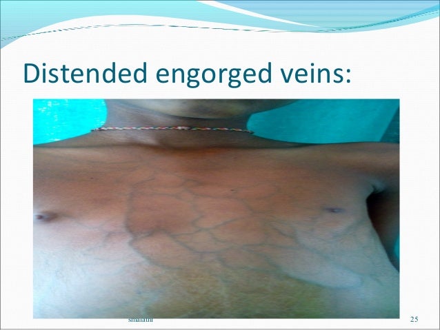 Portal hypertension paediatrics