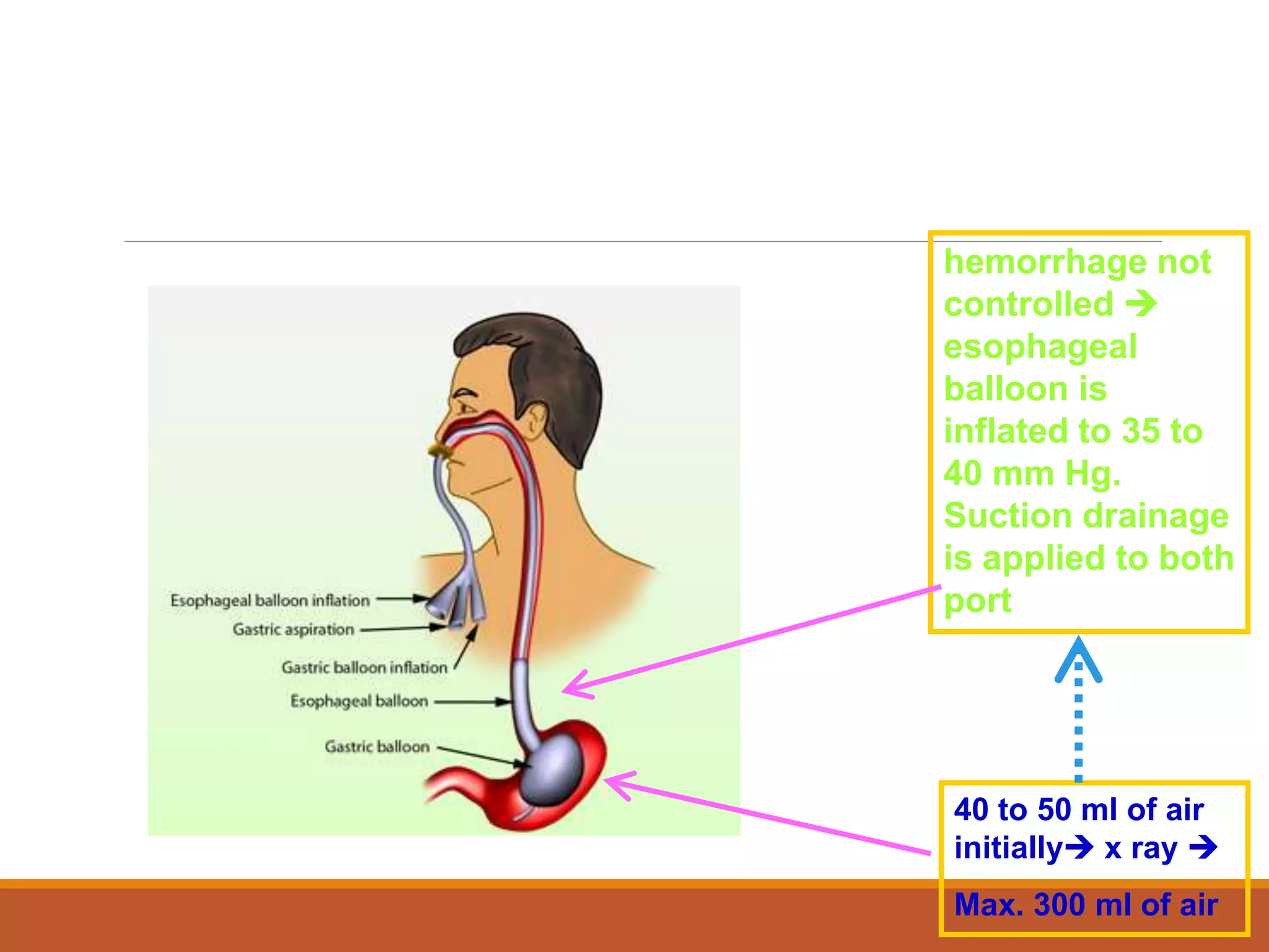 PORTAL HTN spleno renal shunt.ppt