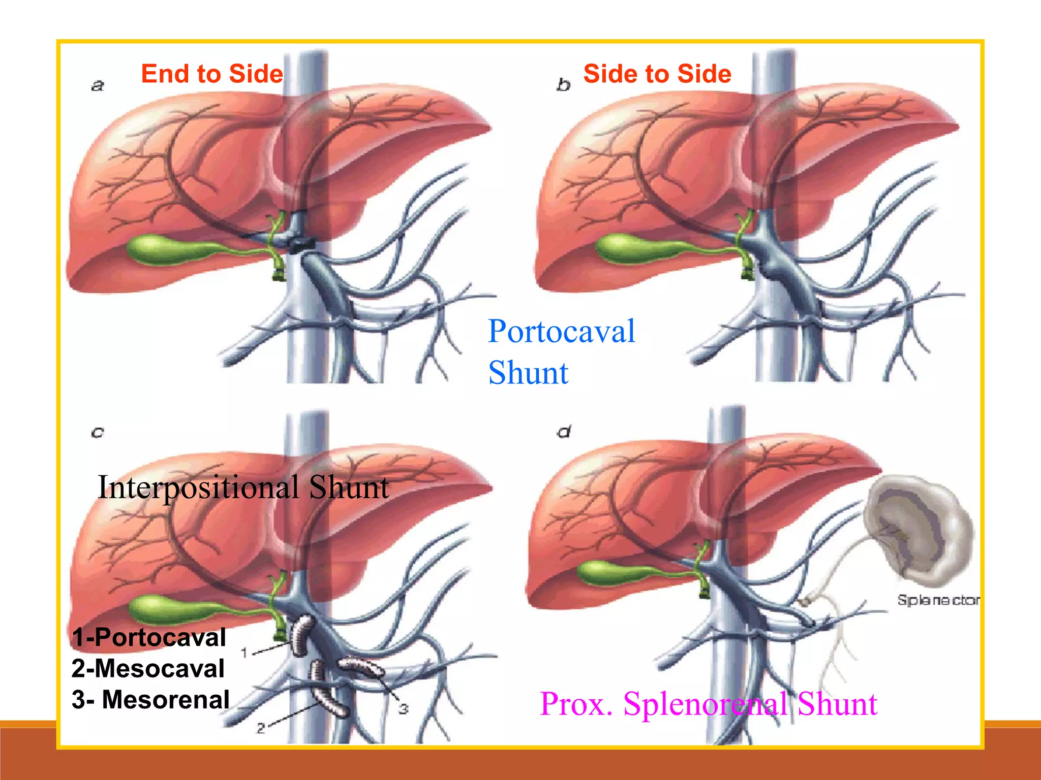 PORTAL HTN spleno renal shunt.ppt