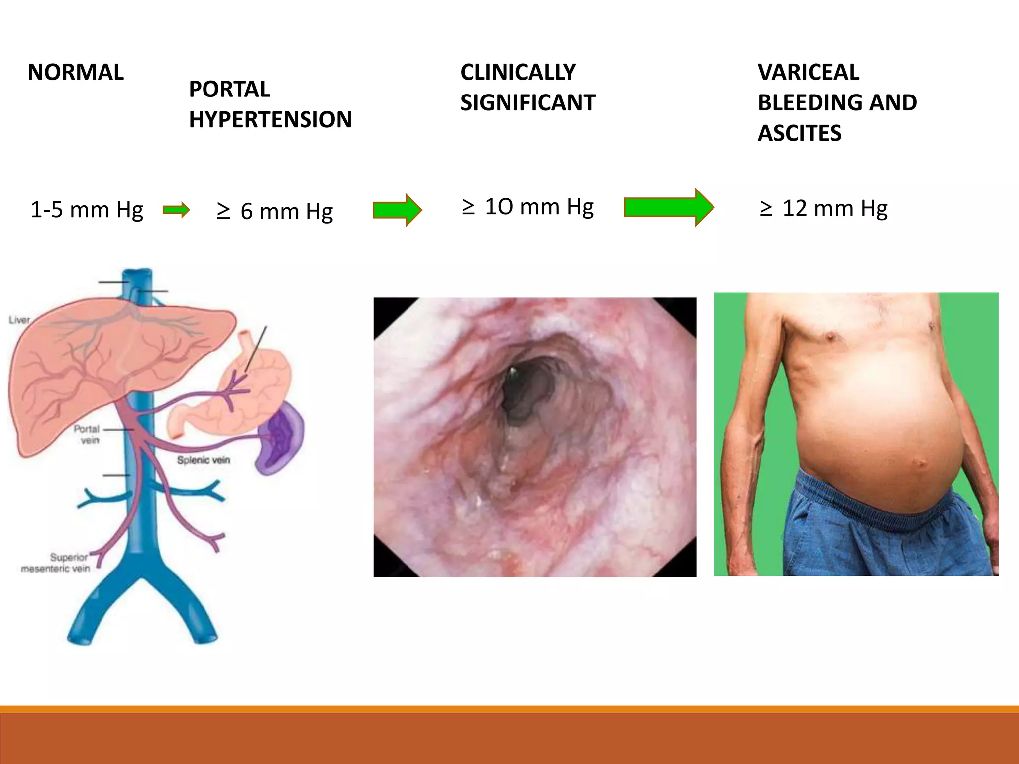 PORTAL HTN spleno renal shunt.ppt