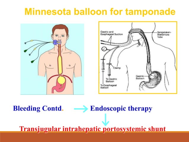 PORTAL HTN spleno renal shunt.ppt | Digestive Disorders | Diseases and ...