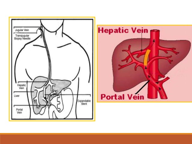 PORTAL HTN spleno renal shunt.ppt | Digestive Disorders | Diseases and ...