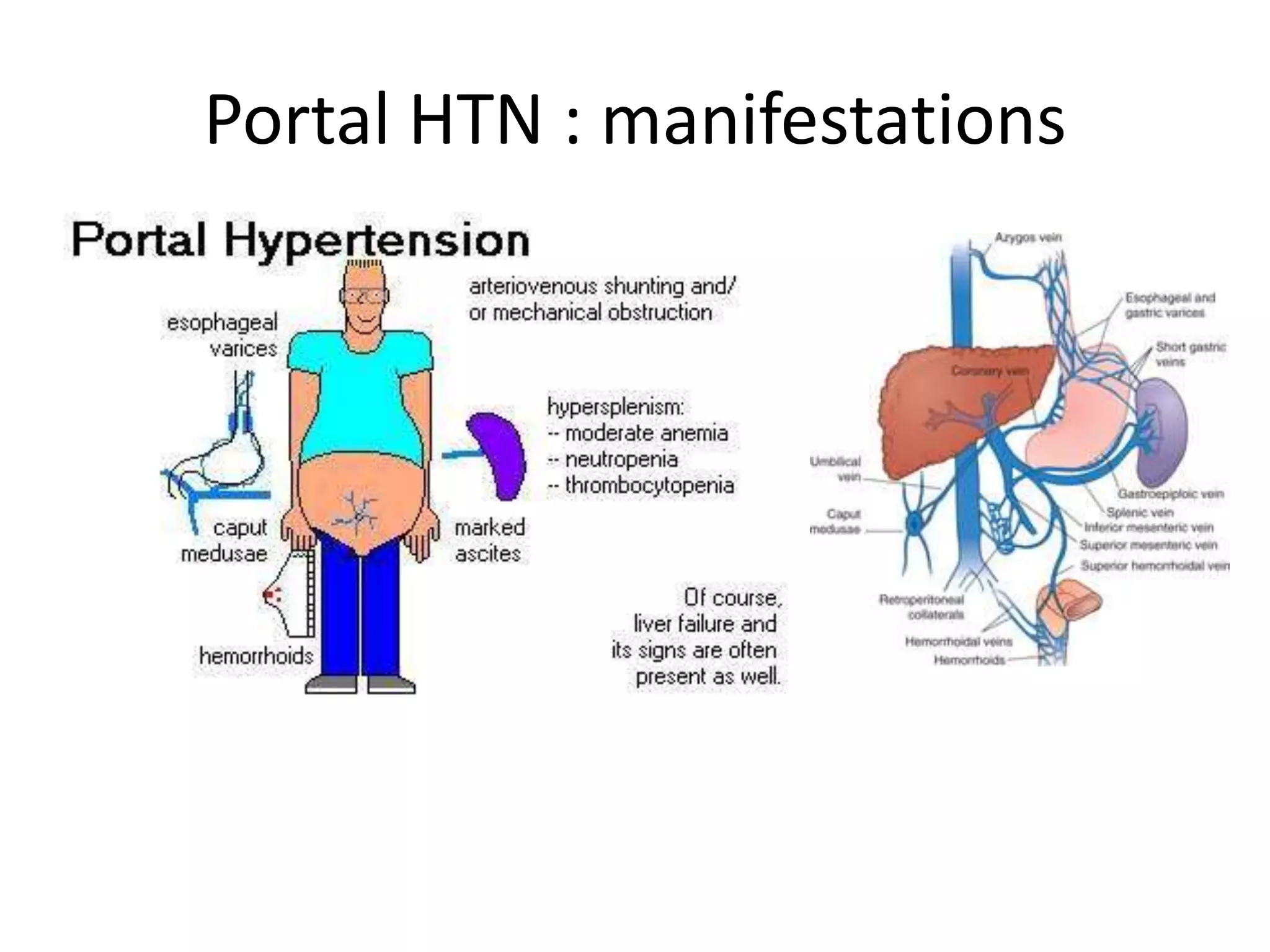 Understanding Portal hypertension | PPTX