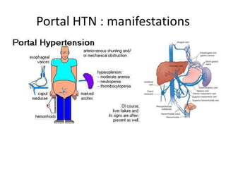 Understanding Portal hypertension | PPTX | Heart and Cardiovascular ...