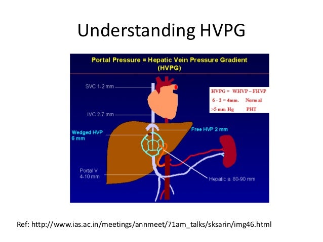Understanding Portal hypertension