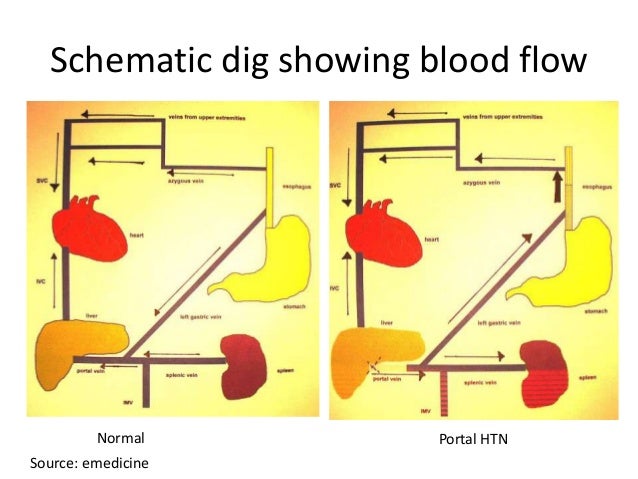 Understanding Portal hypertension