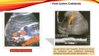 Portal hypertension | PPTX