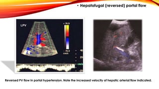 Portal hypertension | PPTX