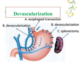 Portal hypertension | PPTX