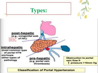 Portal hypertension | PPTX
