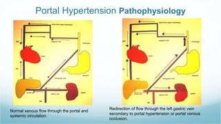 Portal Hypertension in Children | PPTX