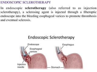 Portal hypertension | PDF | Digestive Disorders | Diseases and Conditions