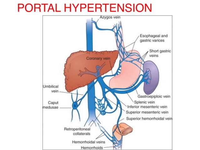 Portal hypertension | PPT