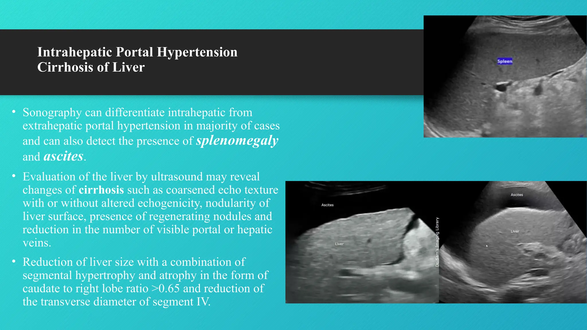 Radiological findings in Portal Hypertension.pptx