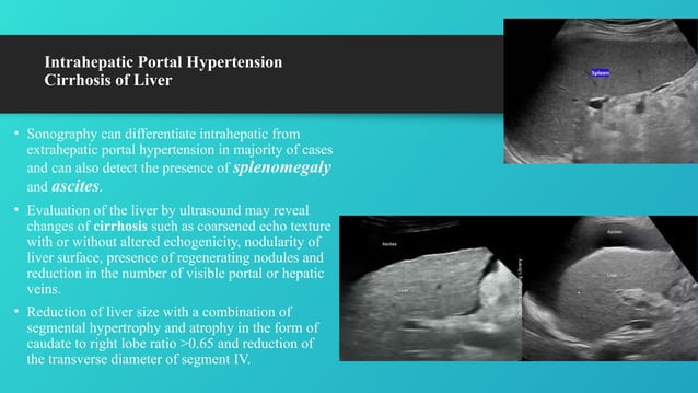 Radiological findings in Portal Hypertension.pptx