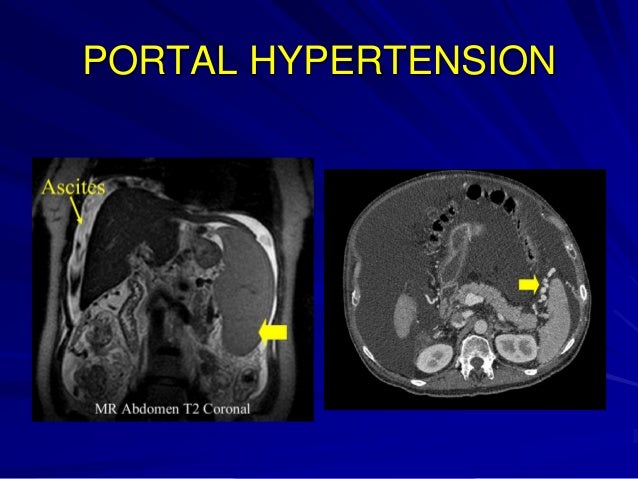 Portal hypertension radiological diagnosis and interventions