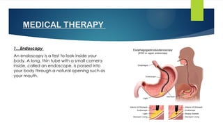 PORTAL HYPERTENSION and it's management (1).pptx