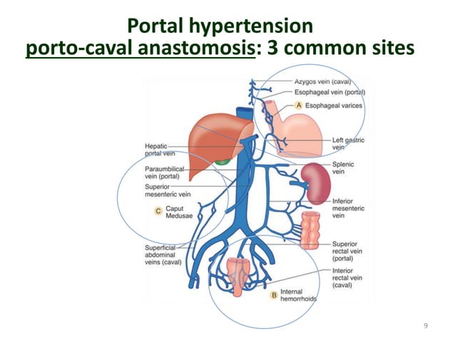 Portal hypertension and gastrointestinal bleeding | PDF | Digestive ...