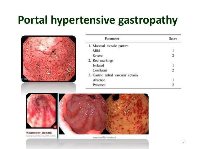 Portal hypertension and gastrointestinal bleeding