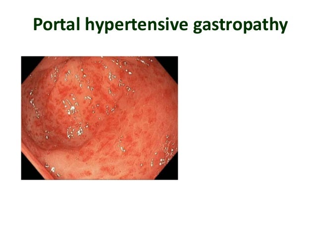 Portal hypertension and gastrointestinal bleeding