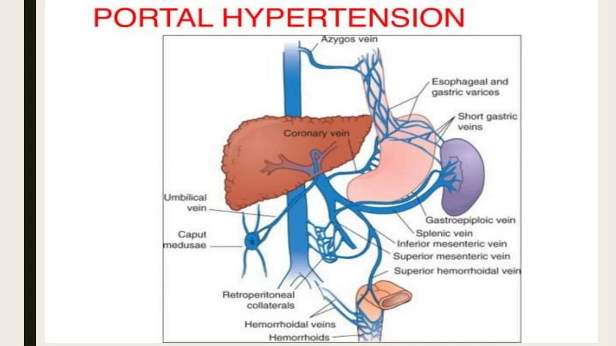 PORTAL HYPERTENSION Adult HealthNursing .pptx