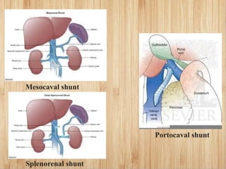 Mesocaval Shunt