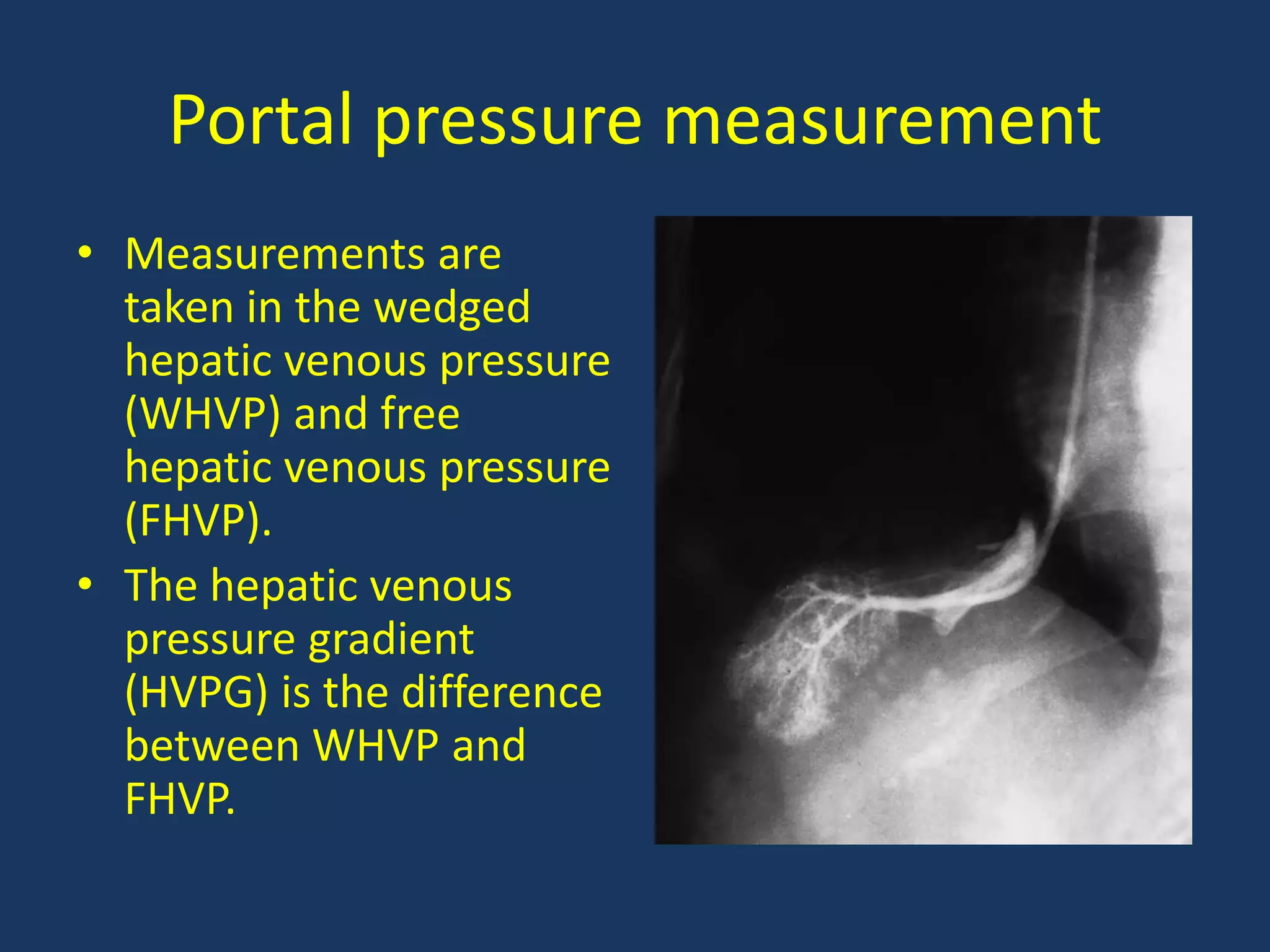 Portal hypertension in paediatrics | PPTX