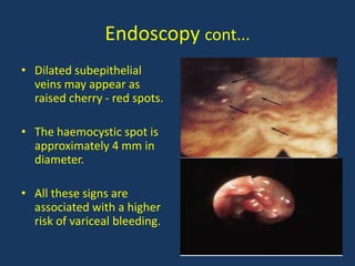 Portal hypertension in paediatrics | PPTX