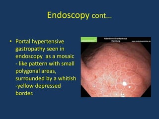 Portal hypertension in paediatrics | PPTX