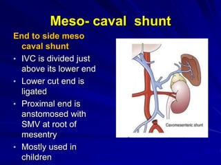 Surgical Anatomy The Mesocaval Shunt