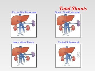 Portal hypertension surgery.pptx | Free Download