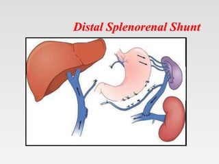 Distal Splenorenal Shunt