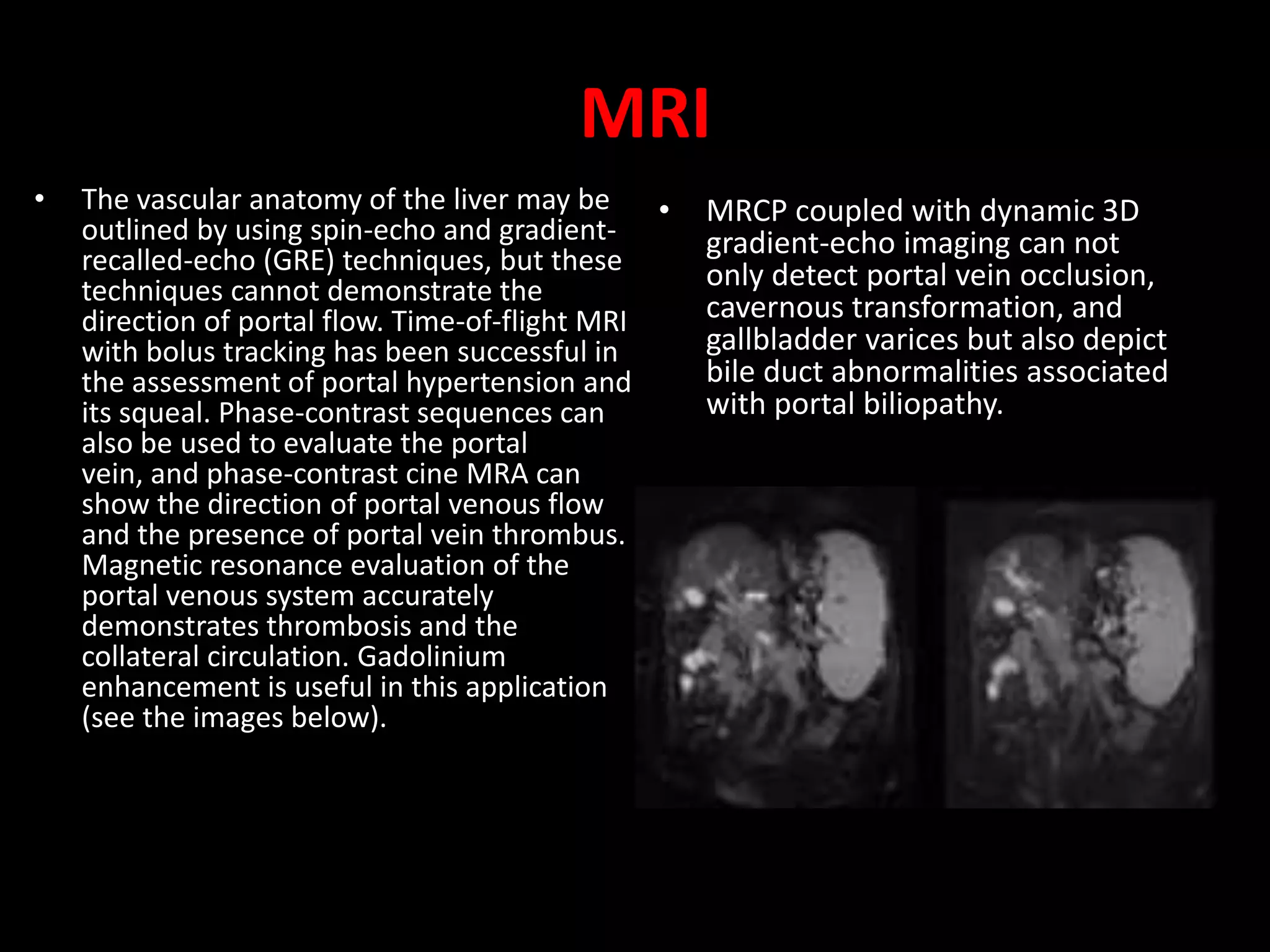 Portal vein thrombosis | PPTX