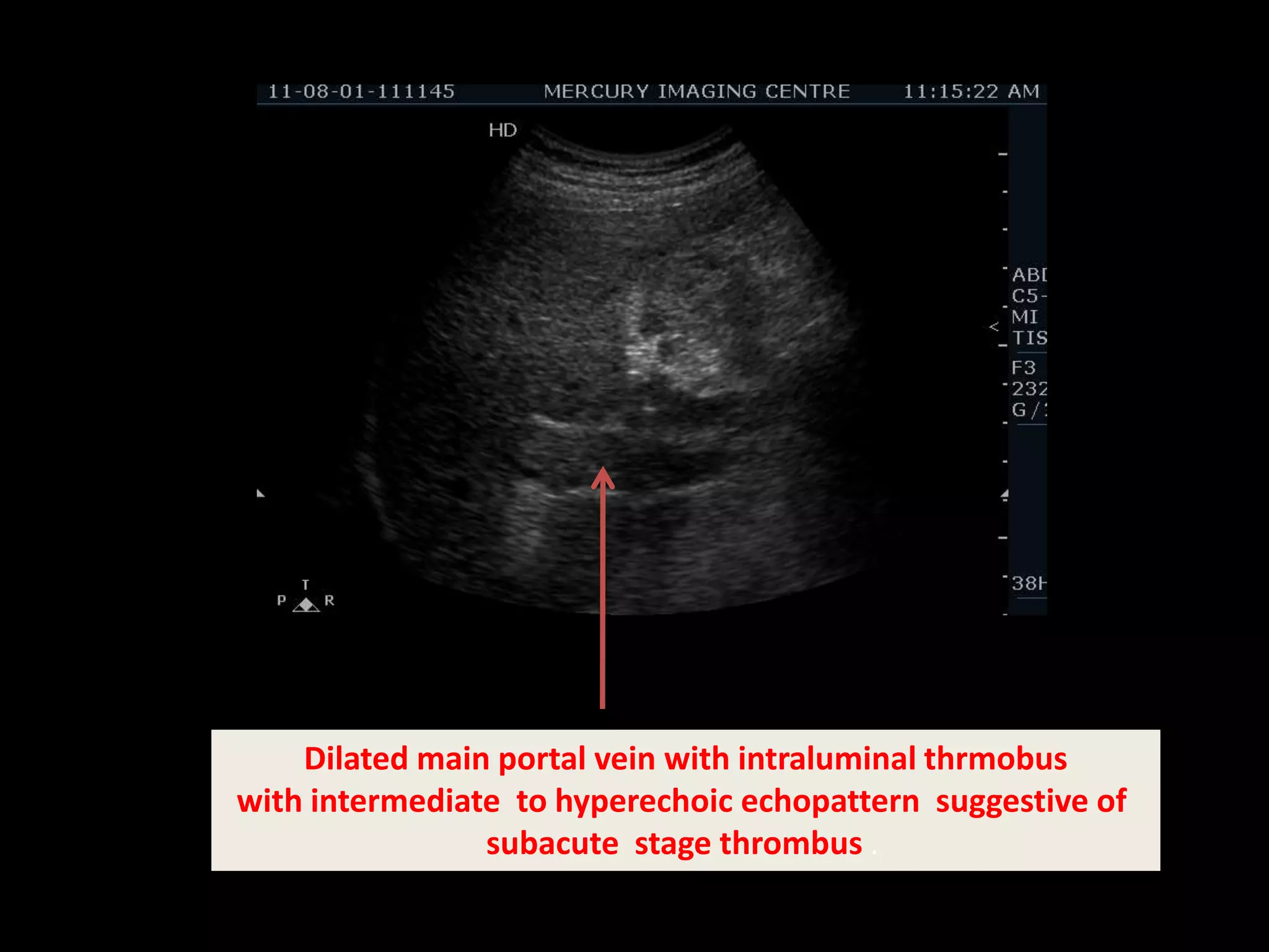 Portal vein thrombosis | PPTX